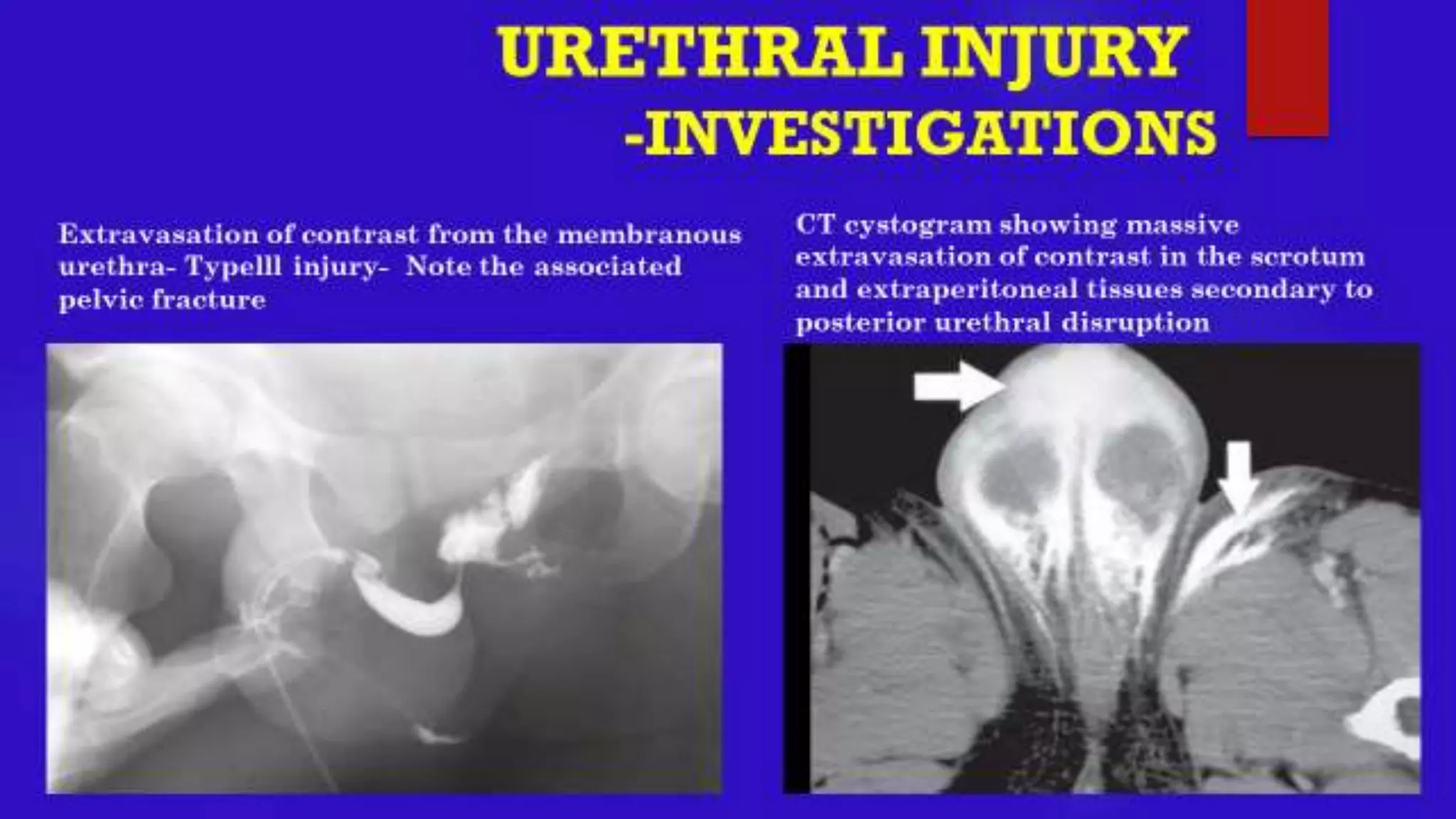 URETHRAL INJURY- Trauma Surgery | PPTX