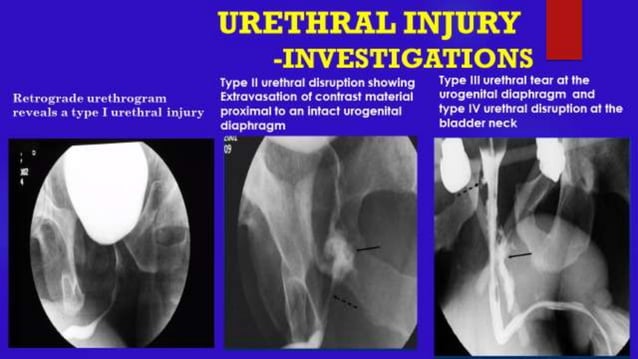 URETHRAL INJURY- Trauma Surgery | PPTX