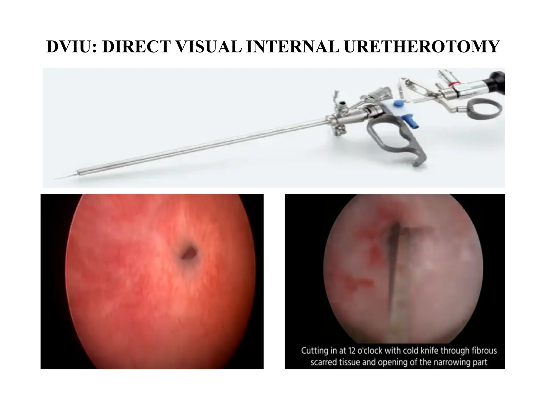 URETHRAL INJURY: BRIEF SURGICAL MANAGEMENT | PPT