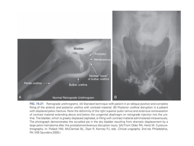 URETHRAL INJURY: BRIEF SURGICAL MANAGEMENT | PPT