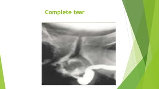 URETHRAL INJURY AND URETHRAL CARUNCLE.pptx