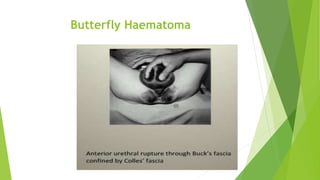 URETHRAL INJURY AND URETHRAL CARUNCLE.pptx