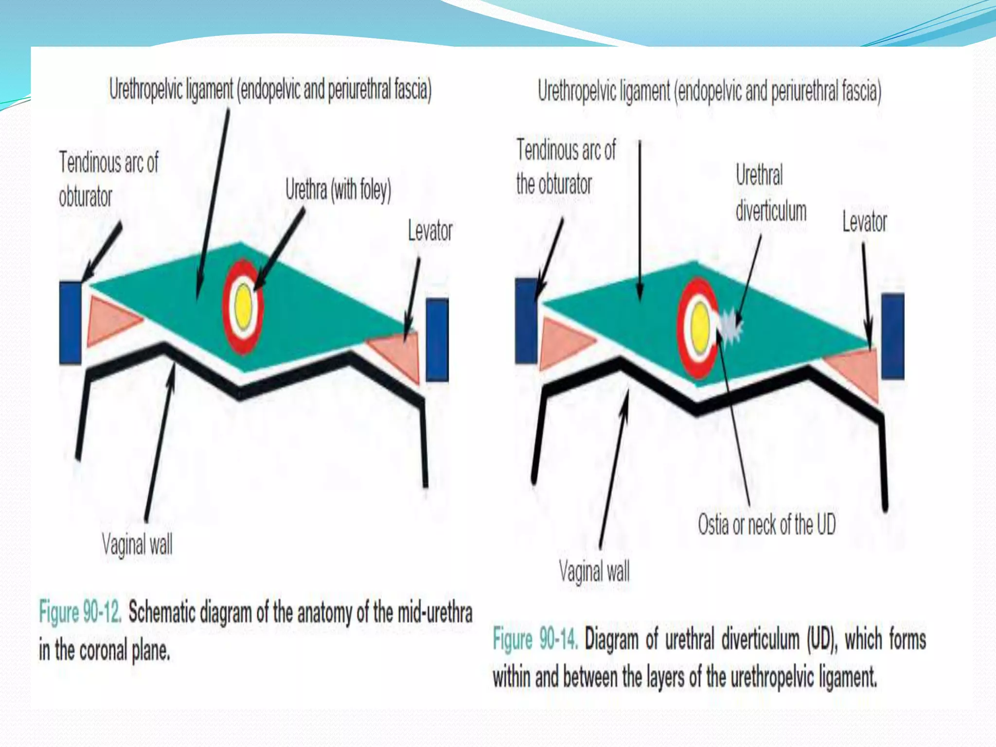 urethral mass DD.pptx