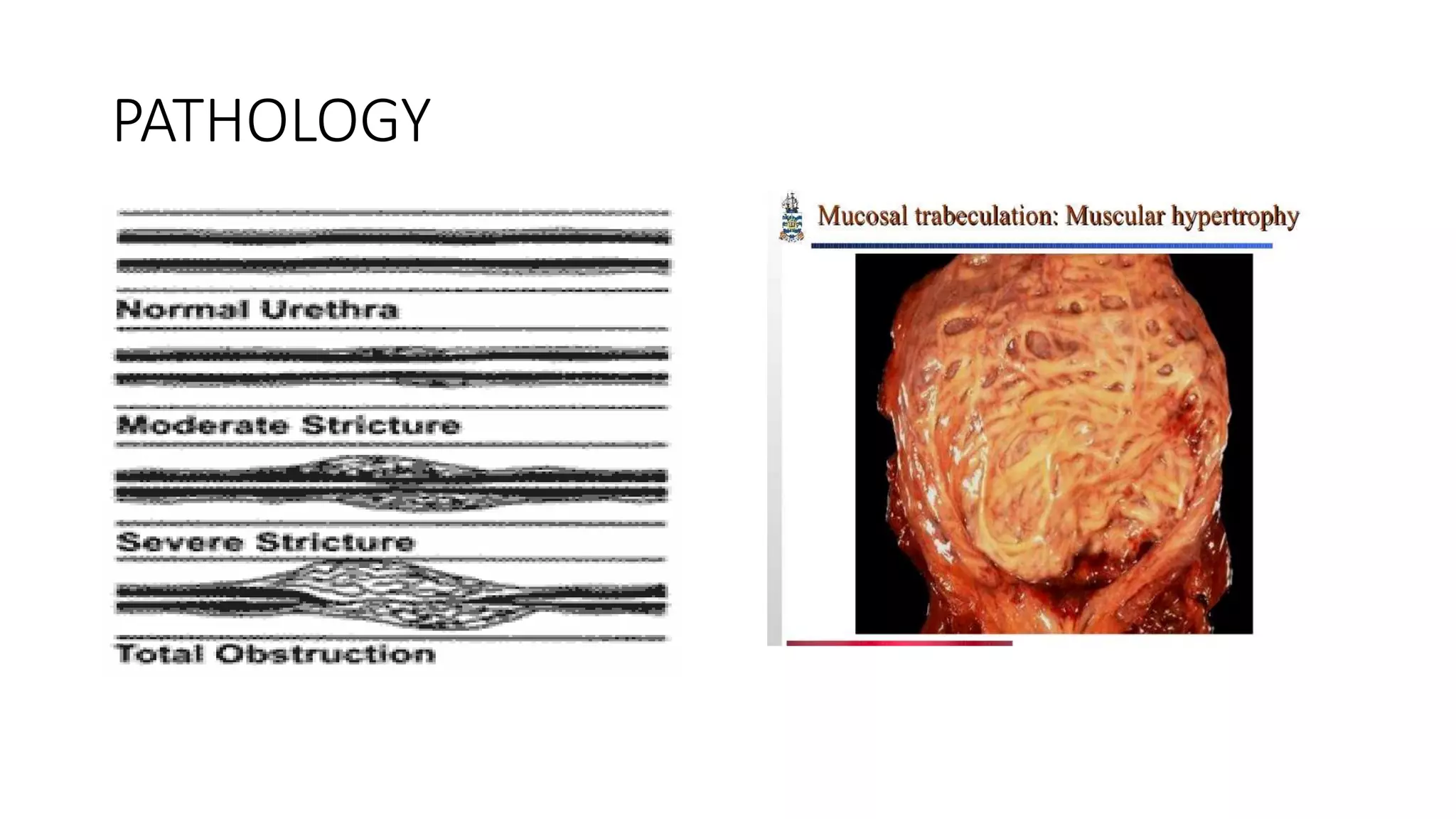 Urethral stricture | PPT