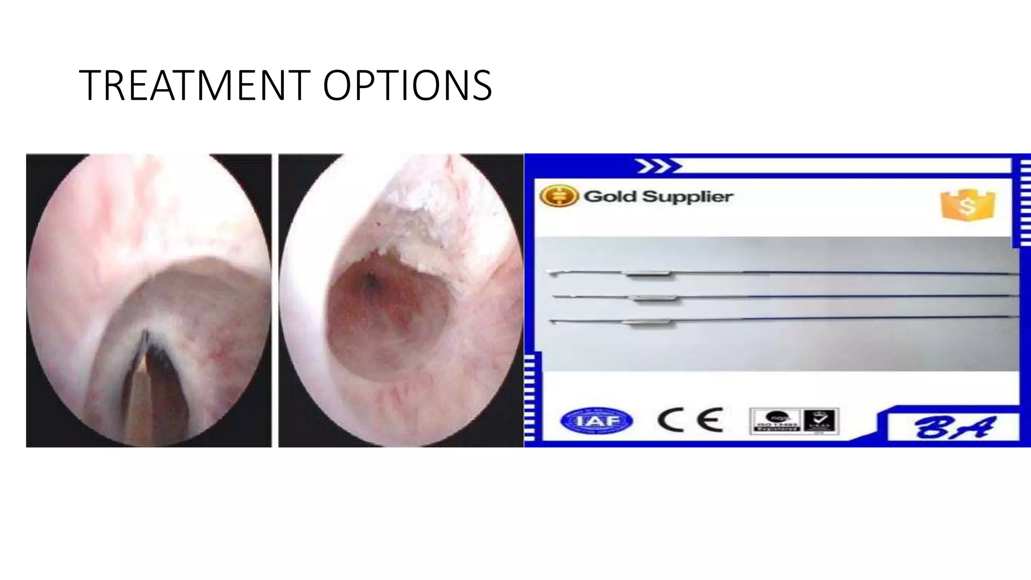 Urethral stricture | PPT