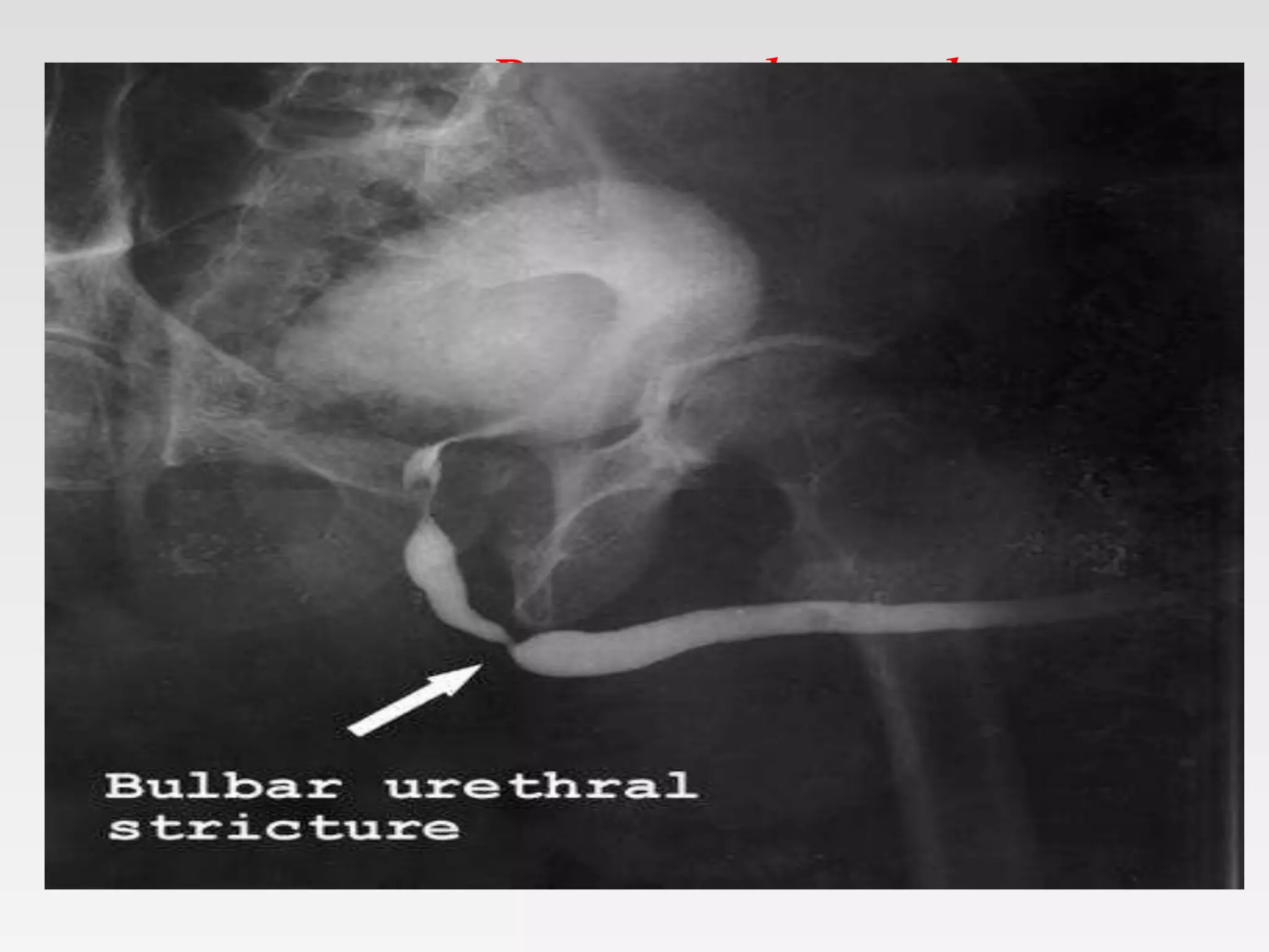 Urethral stricture.pptx