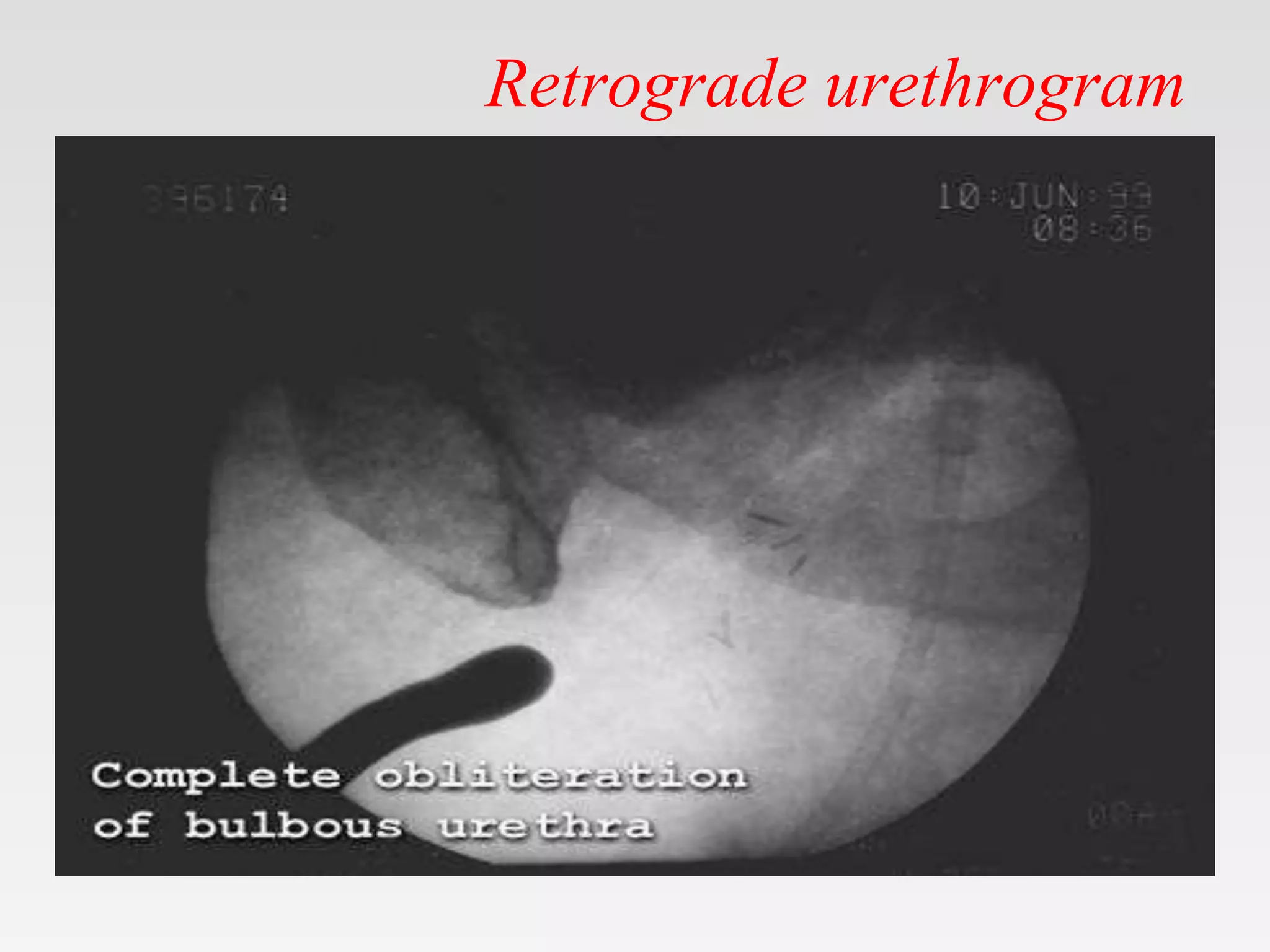Urethral stricture.pptx