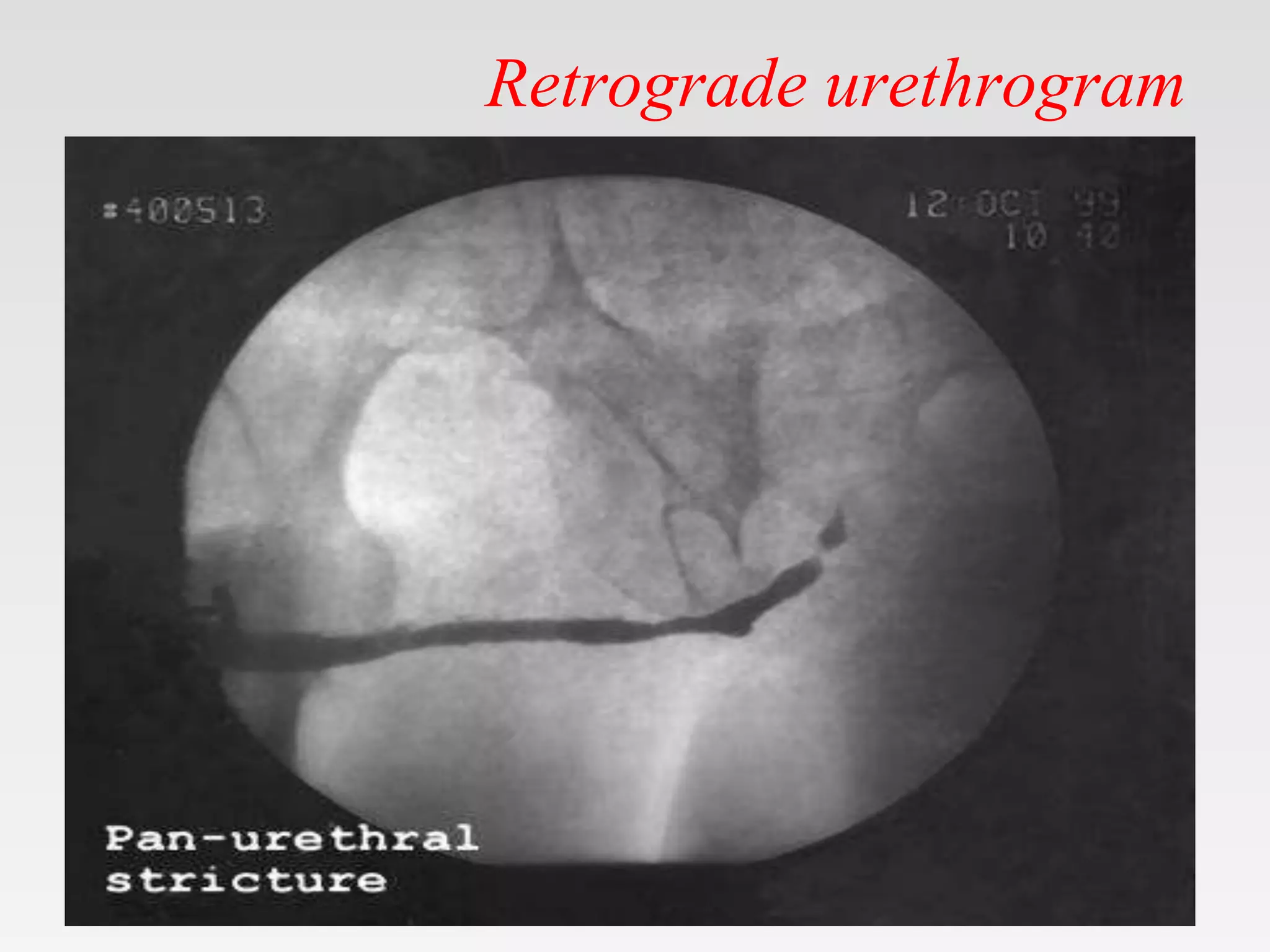 Urethral stricture.pptx