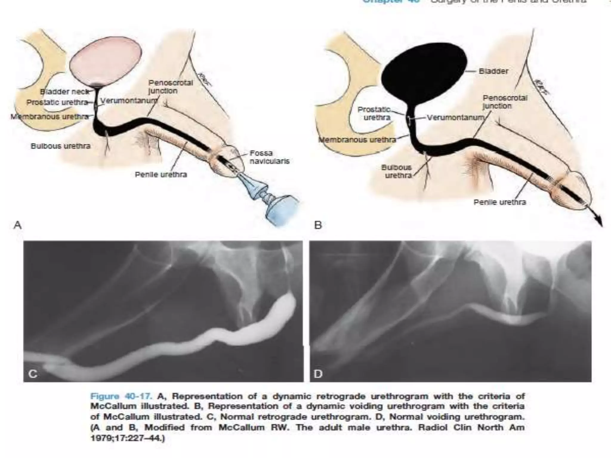 Urethral stricture.pptx