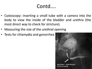 lecture slide on Urethral Stricture.pptx
