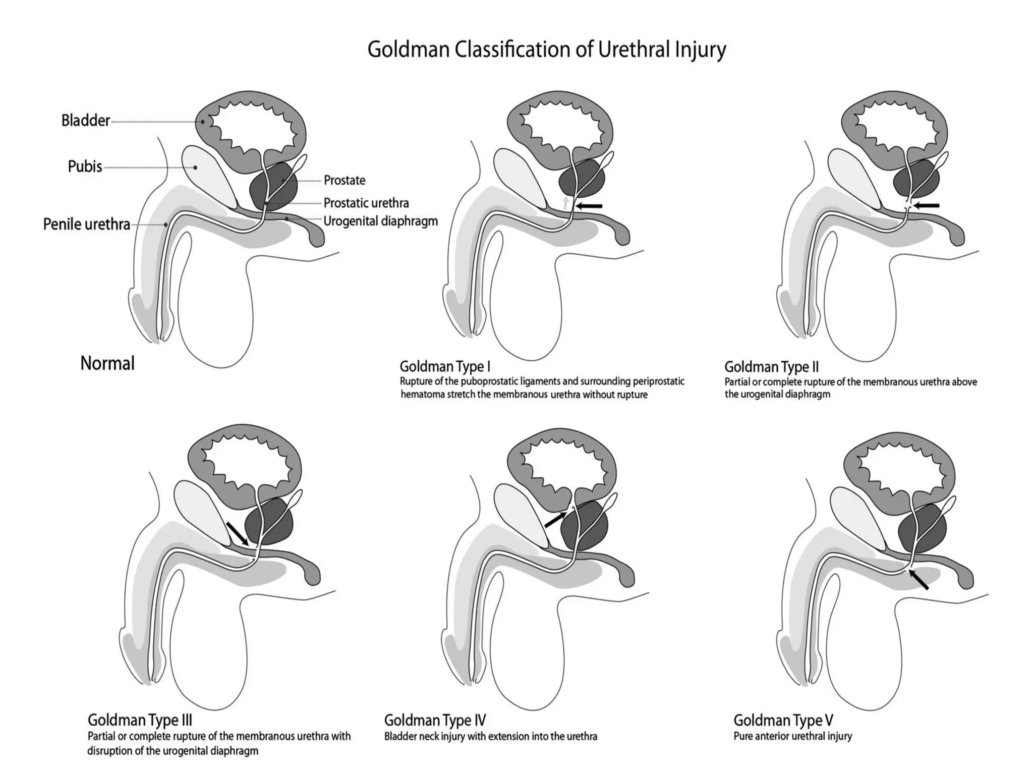 URETHRAL STRICTURE MAIN.pptxAbnormal narrowing of a segment of the ...