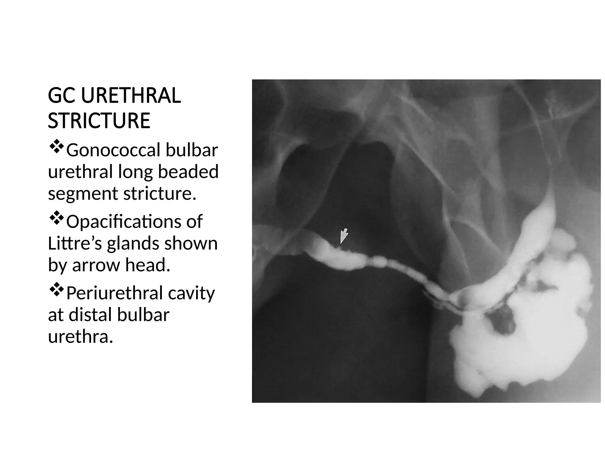 URETHRAL STRICTURE MAIN.pptxAbnormal narrowing of a segment of the ...