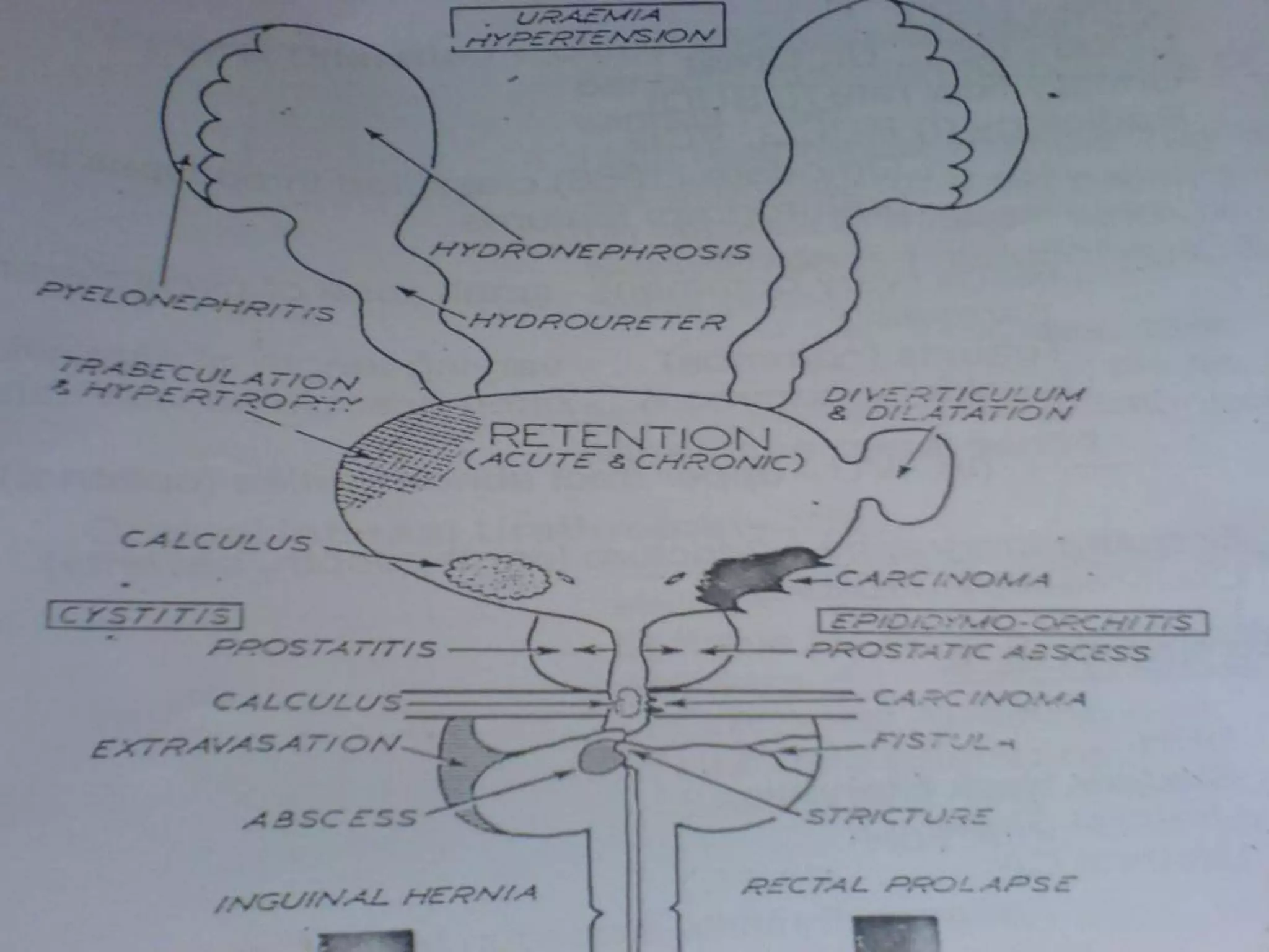 Pathology of Urethral strictures | PPTX