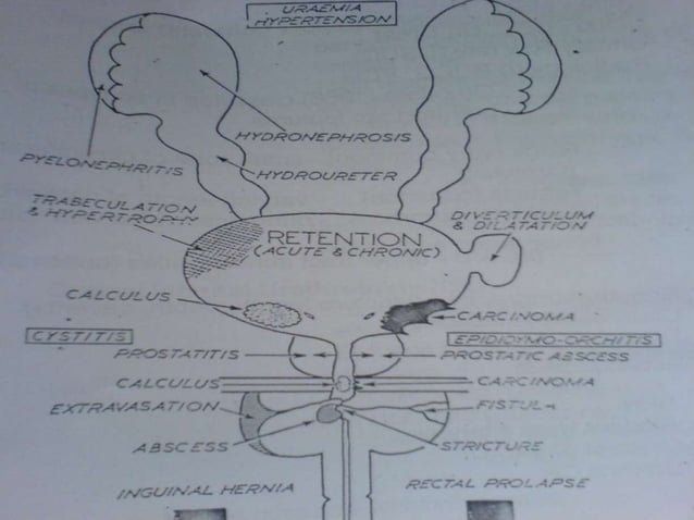 Pathology of Urethral strictures | PPTX