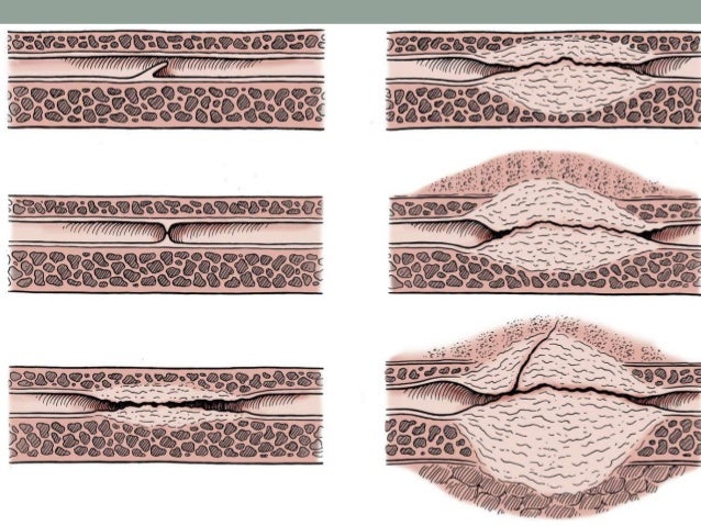 Urethral stricture pathology