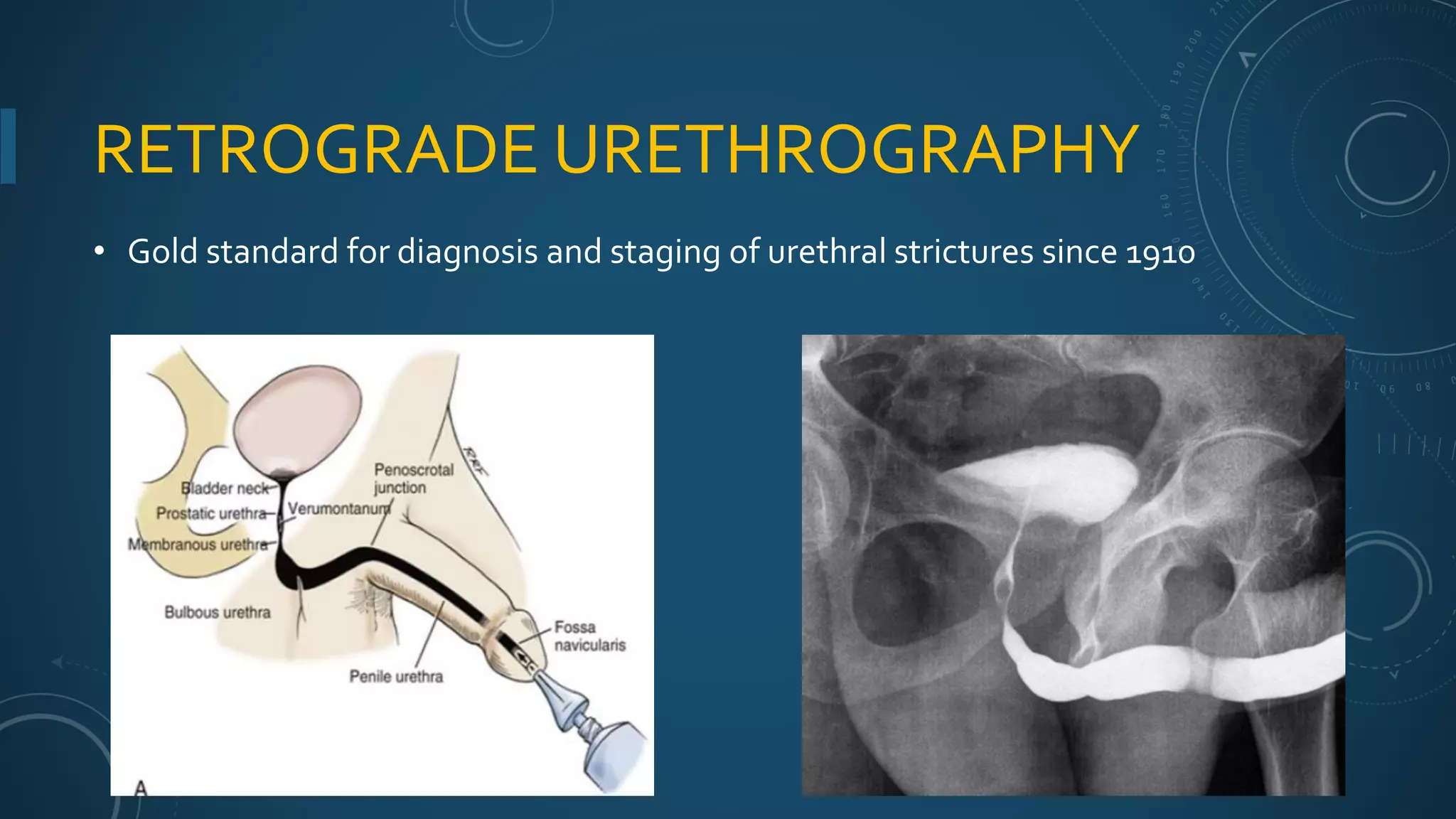 Urethral strictures | PPTX