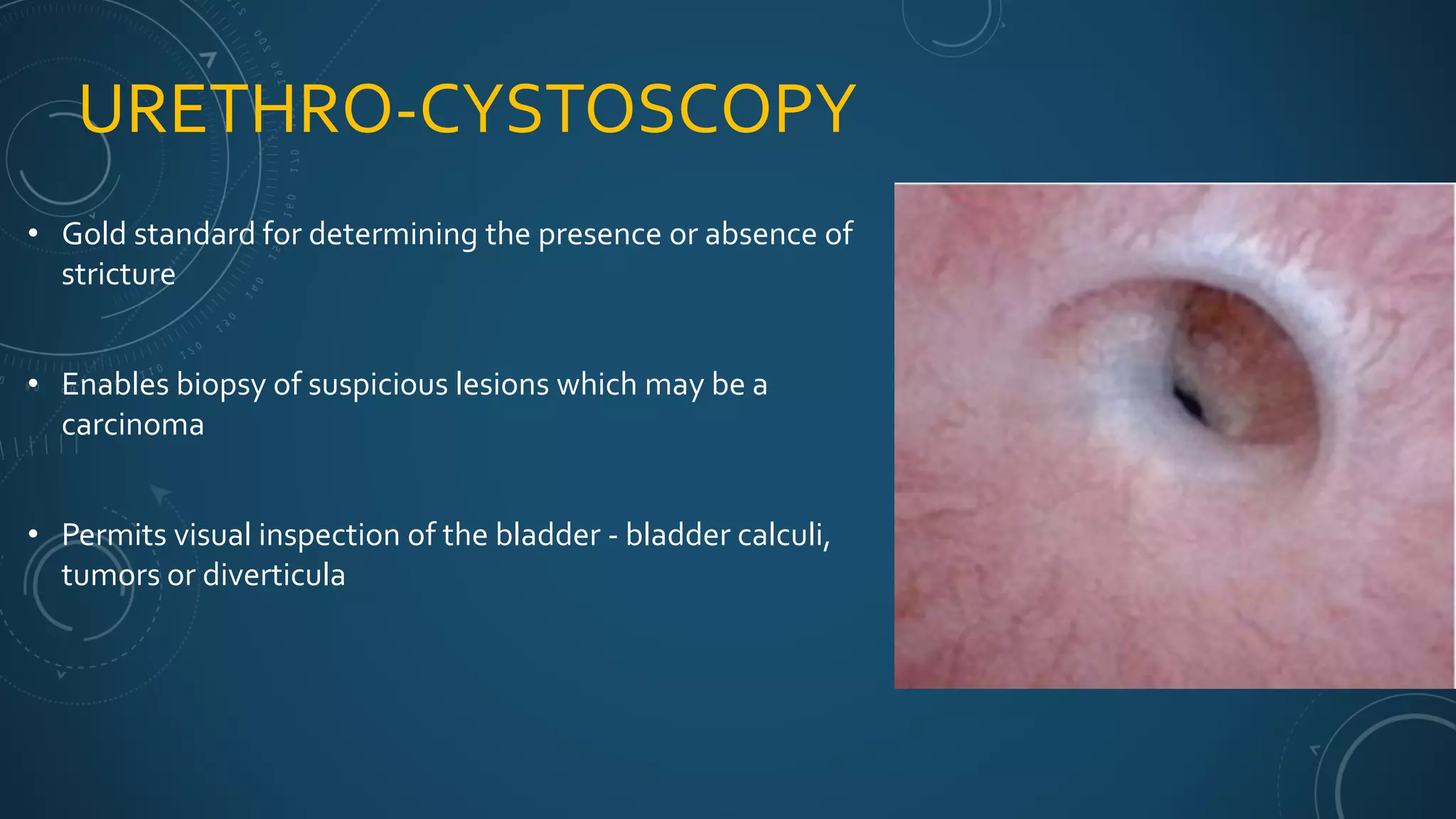 Urethral strictures | PPTX