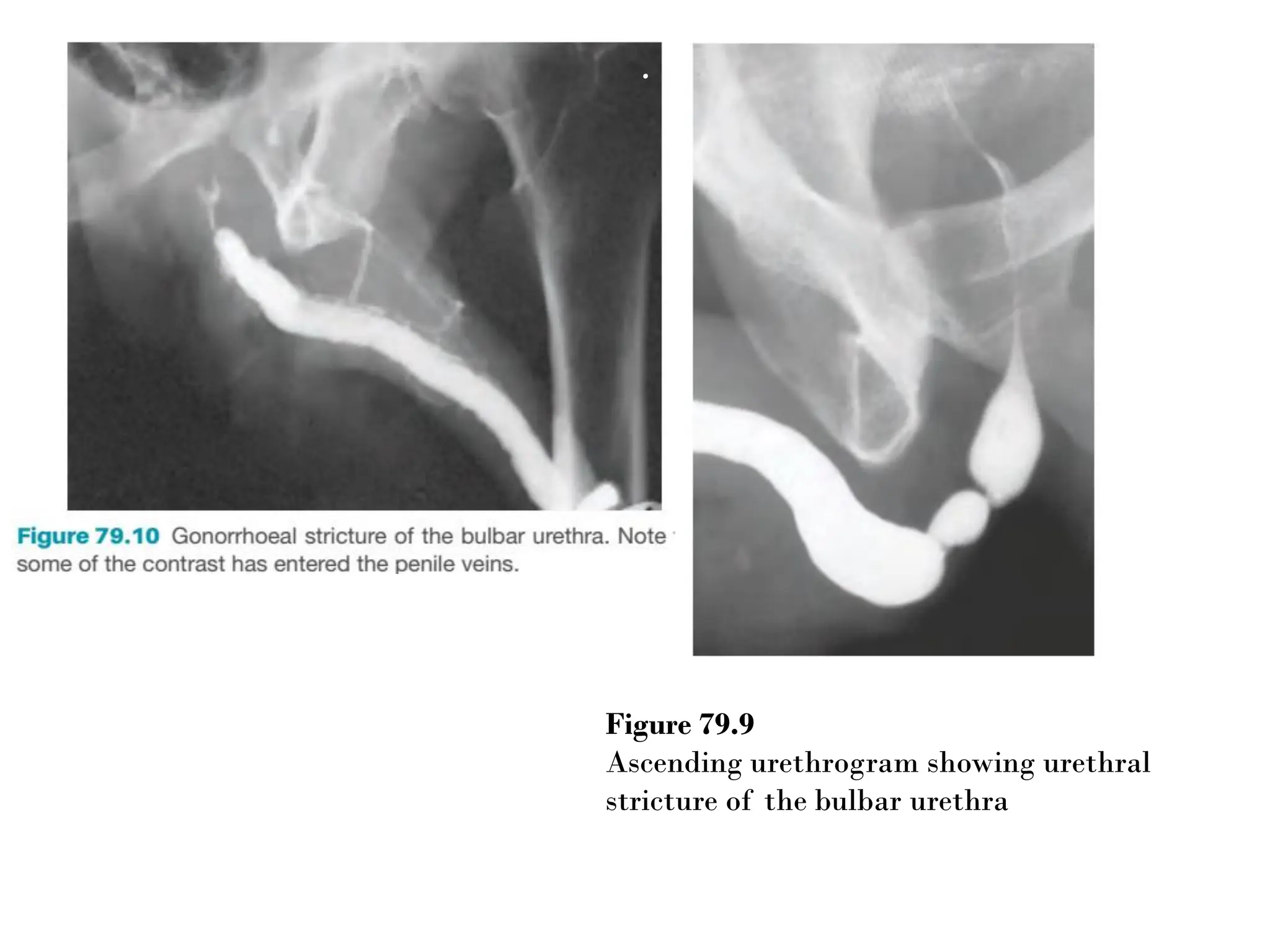 LECTURE NOTE ON URETHRAL STRICTURES AND STENOSIS.pdf