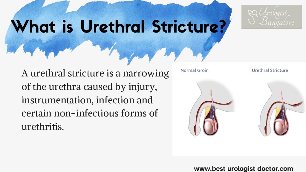 Urethral Stricture Treatment Best Treatment For Urethral Stricture