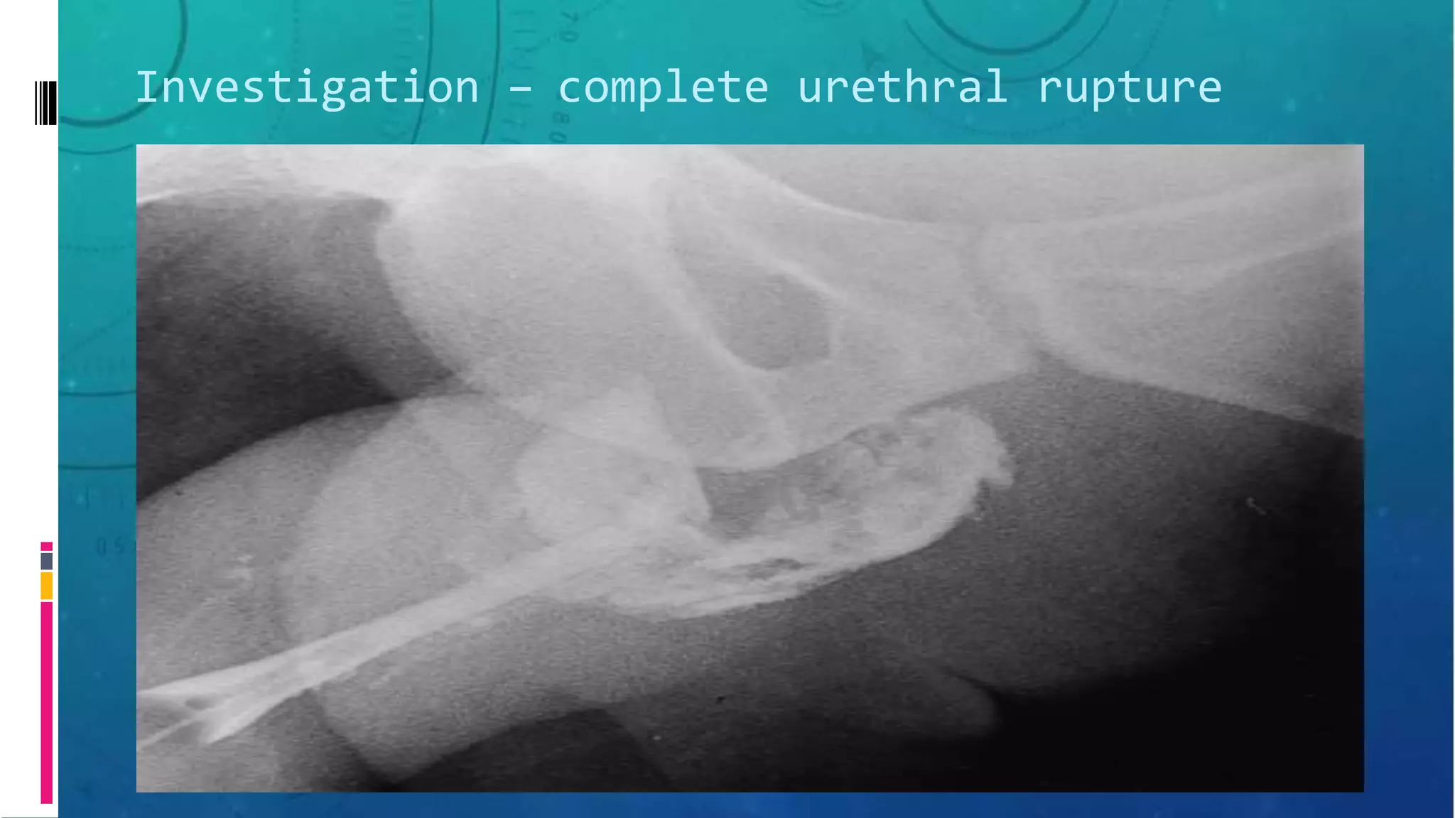 Urethral trauma | PPTX