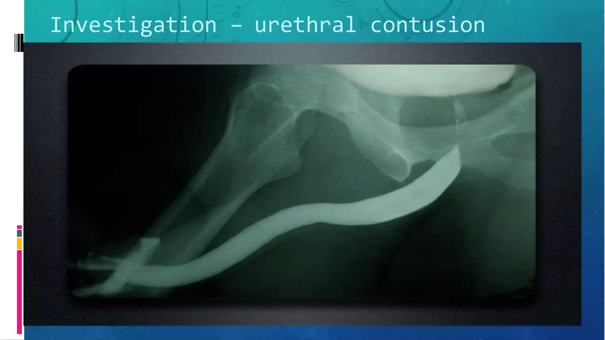 Urethral trauma | PPTX