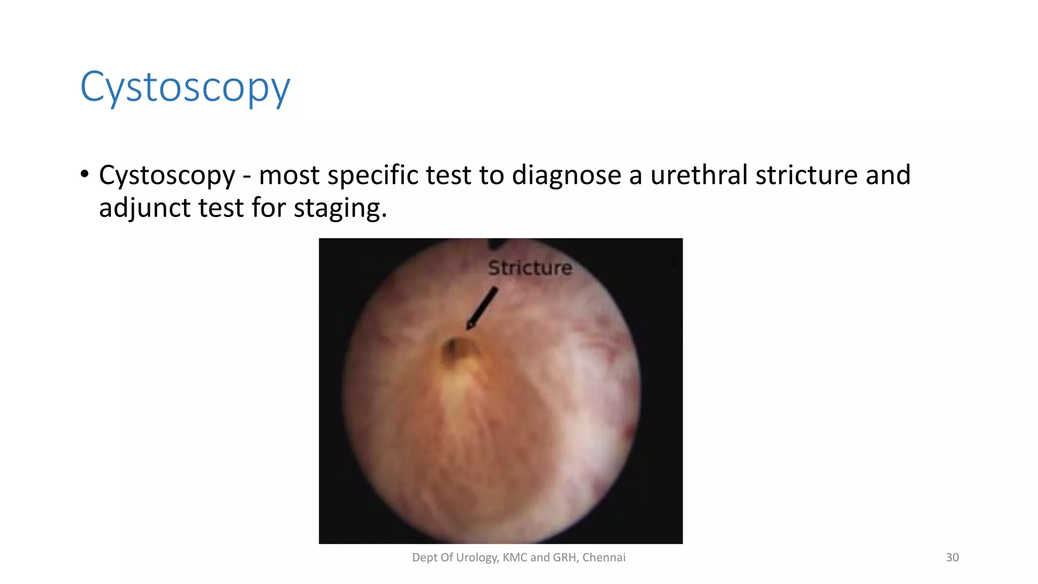 Urethra stricture overview | PDF | Sexual Conditions | Sexual Health