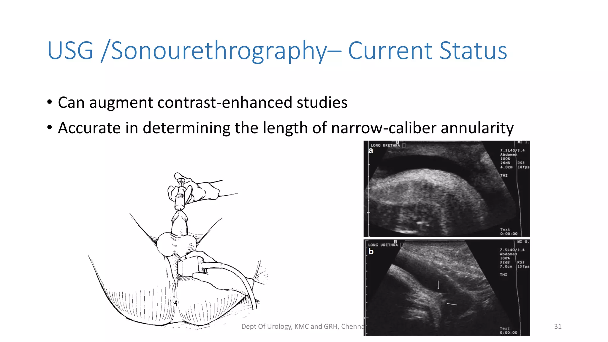 Urethra stricture overview | PDF