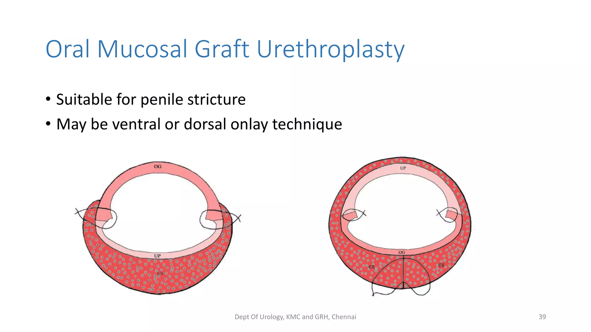 Urethra stricture overview | PDF