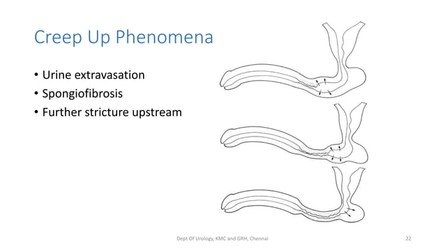 Urethra stricture overview | PDF | Sexual Conditions | Sexual Health