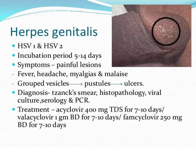 Urethritis