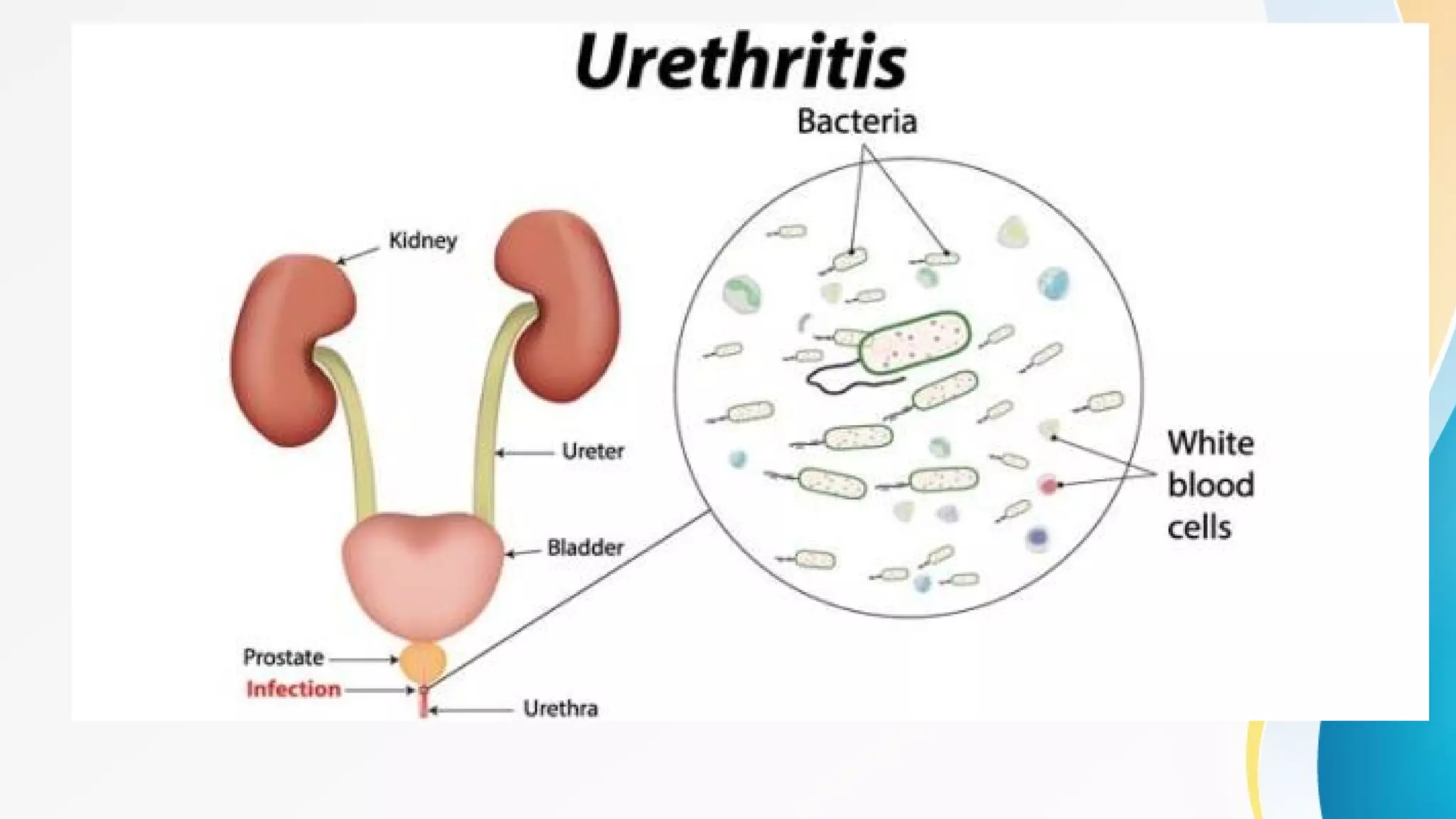 Urethritis | PPT