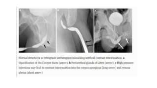 urethrogram.pptx | Reproductive Health | Diseases and Conditions