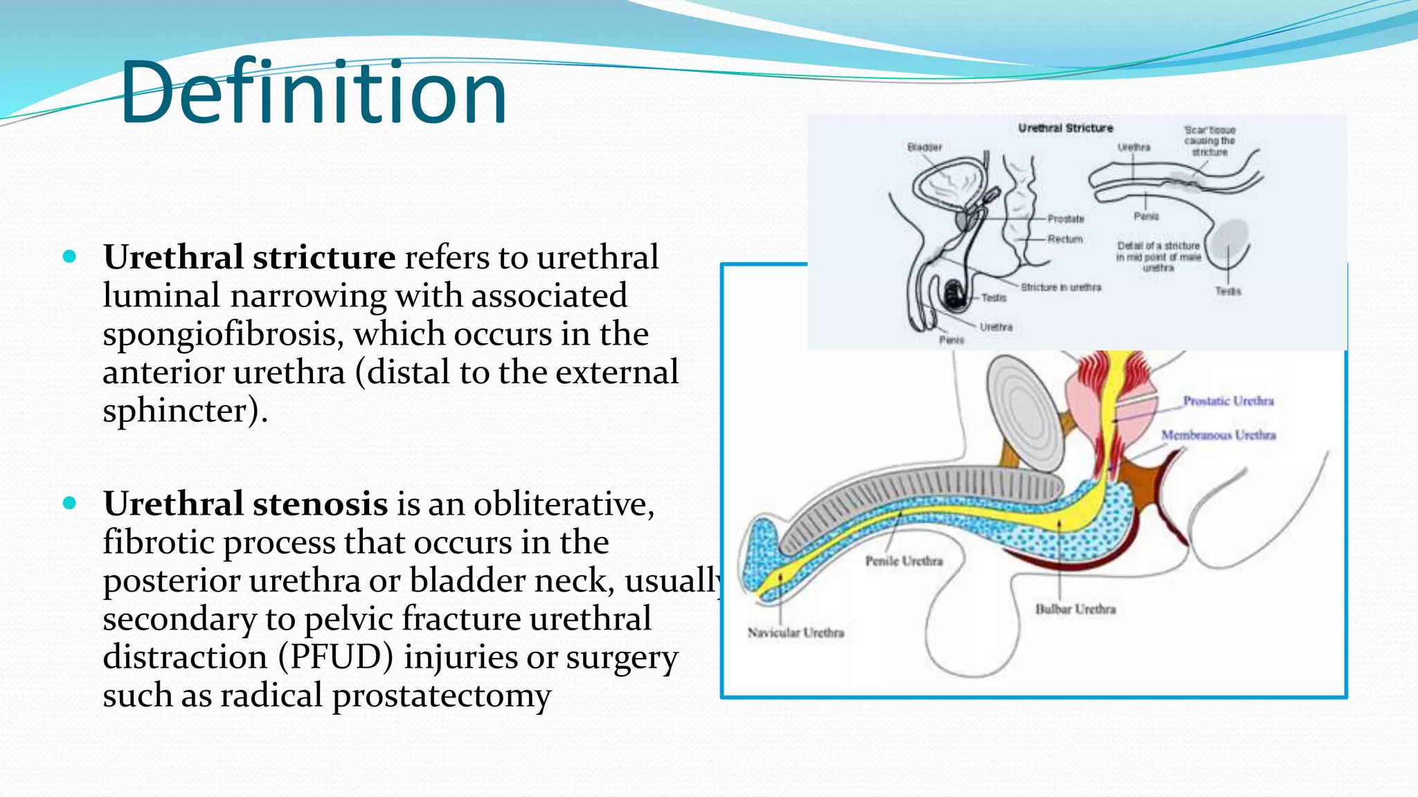 Urethroplasty principles and practicess.pptx | Surgery | Medical Health