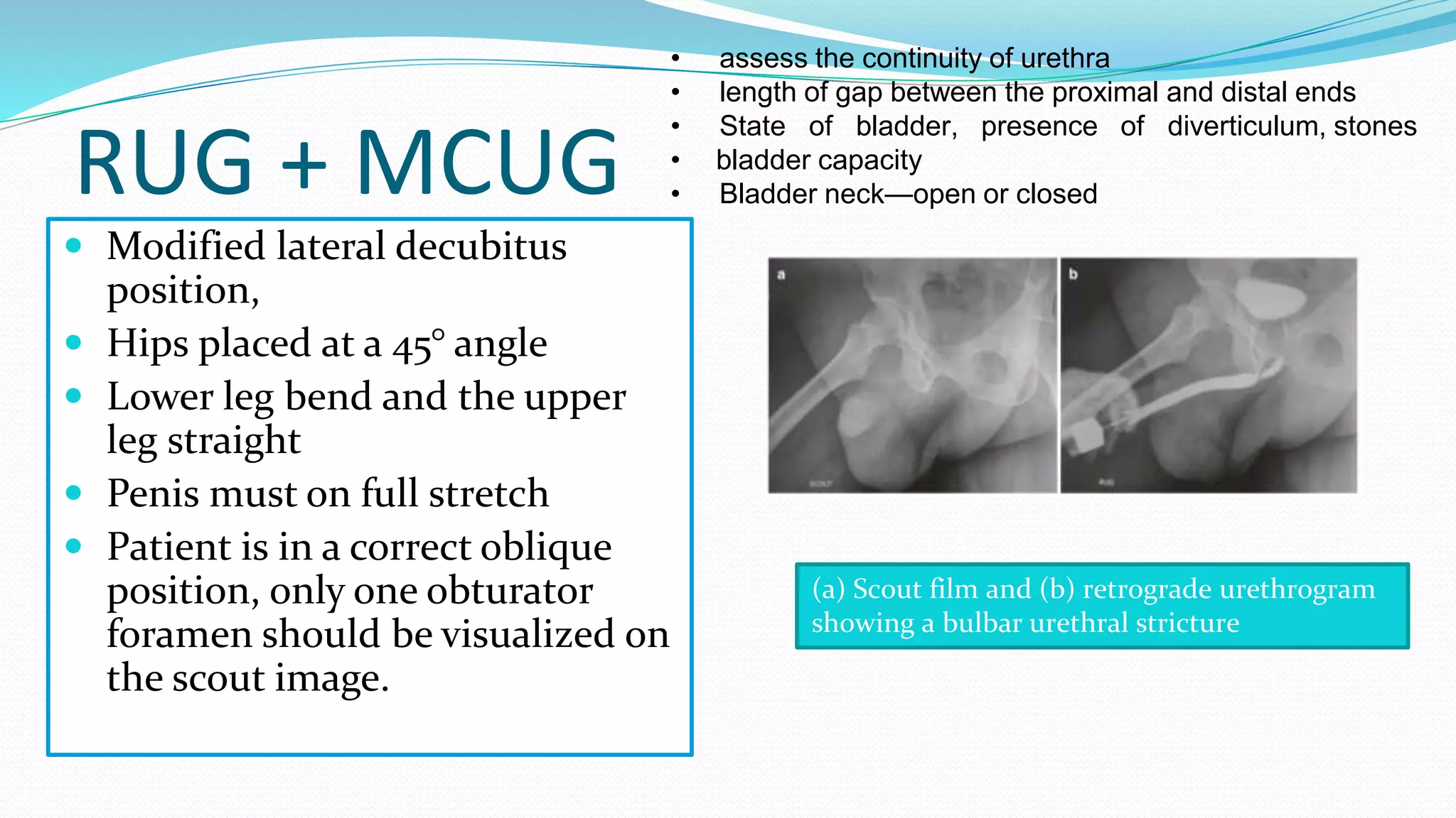 Urethroplasty principles and practicess.pptx