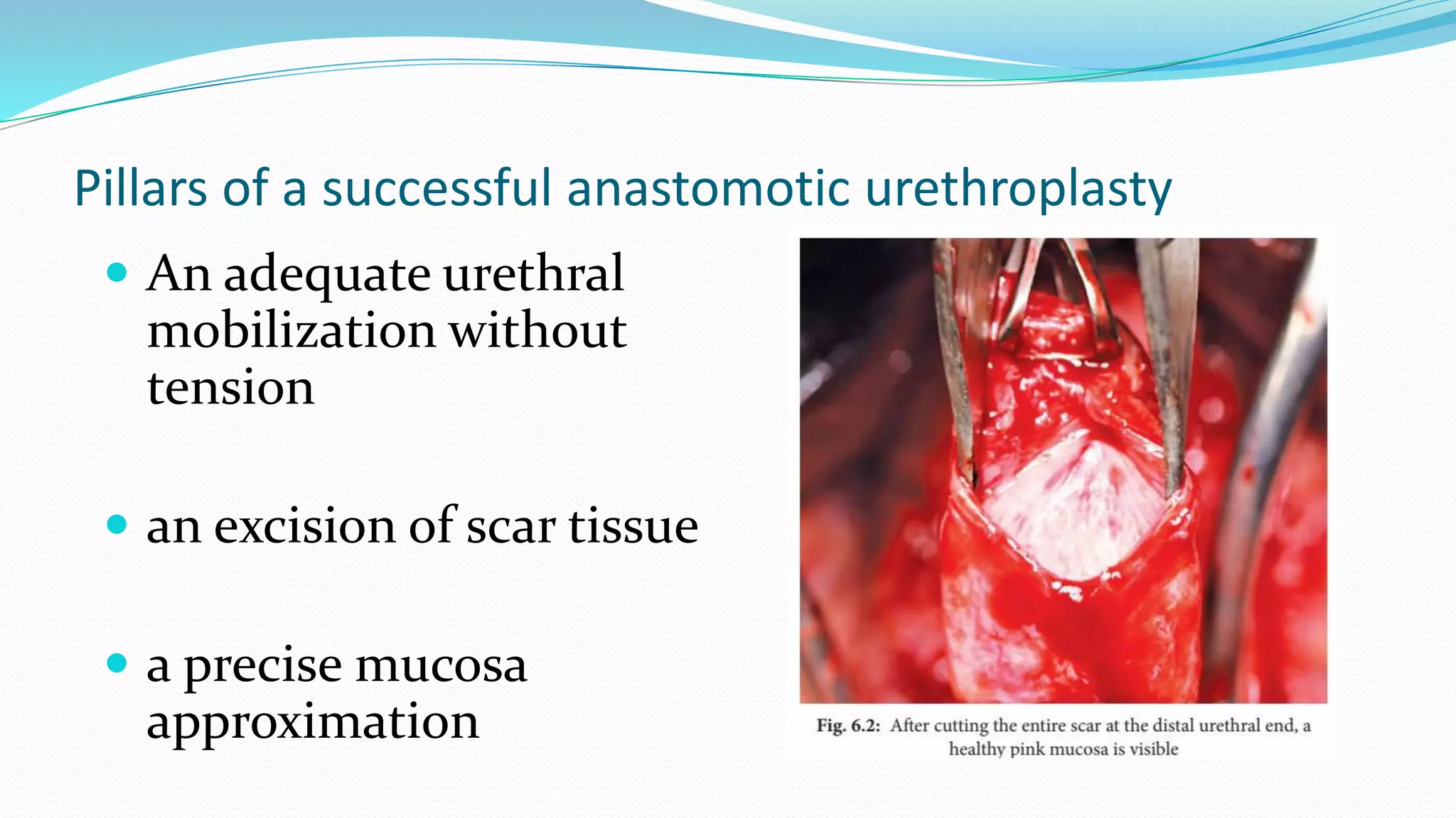 Urethroplasty principles and practicess.pptx