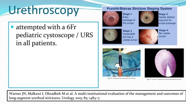 Urethroplasty principles and practicess.pptx | Surgery | Medical Health