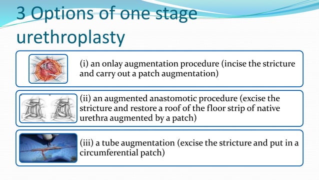Urethroplasty principles and practicess.pptx | Surgery | Medical Health