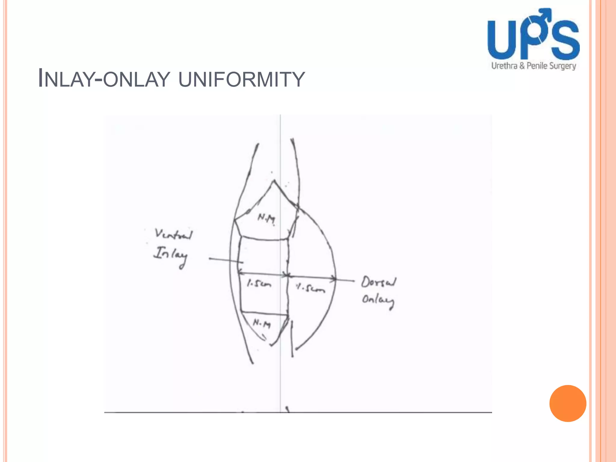 Urethroplasty Treatment | PPTX