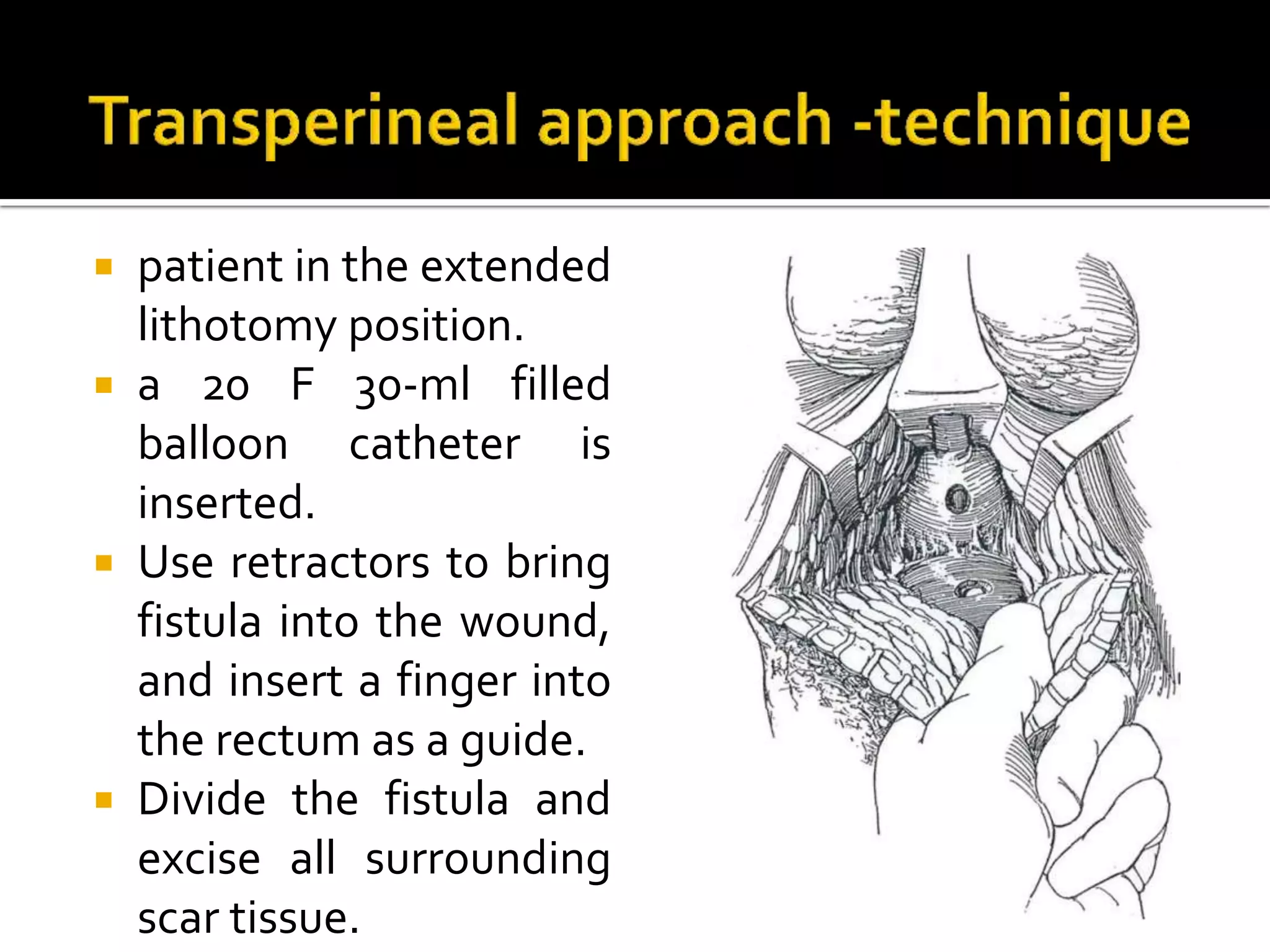 Urethrorectal fistula | PDF