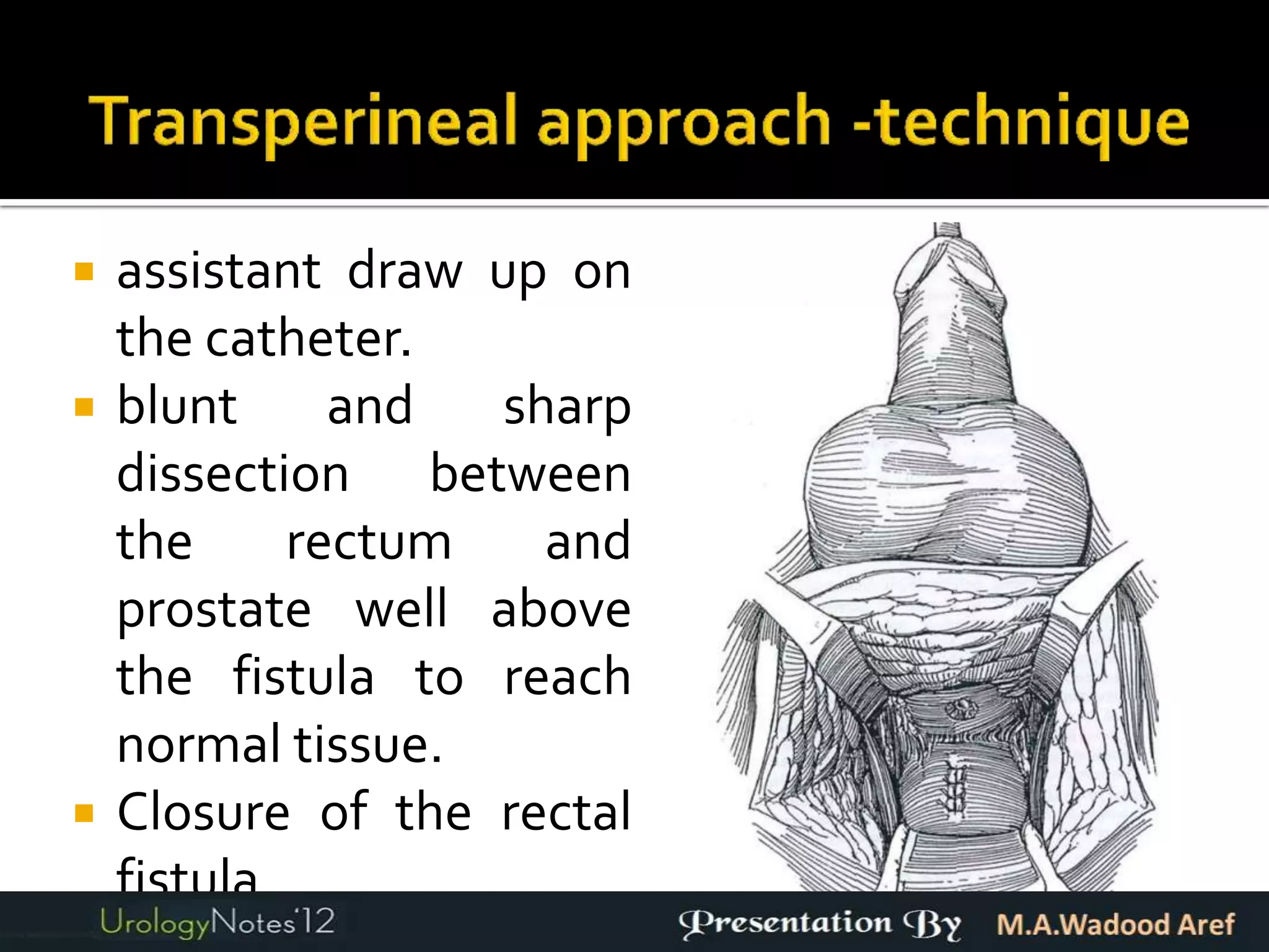 Urethrorectal fistula | PDF