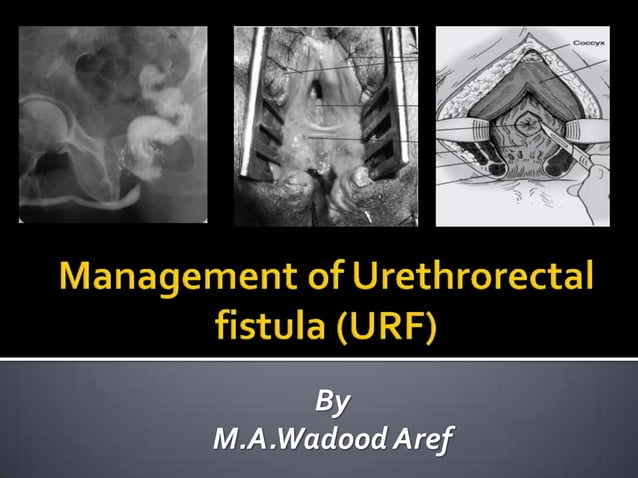 Urethrorectal fistula | PDF | Digestive Disorders | Diseases and Conditions