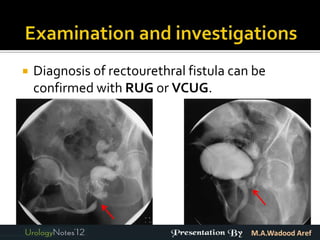 Urethrorectal fistula | PDF
