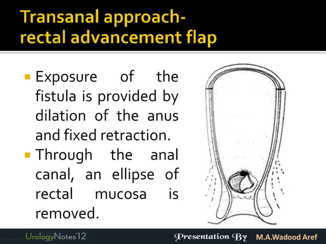 Urethrorectal fistula | PDF | Digestive Disorders | Diseases and Conditions