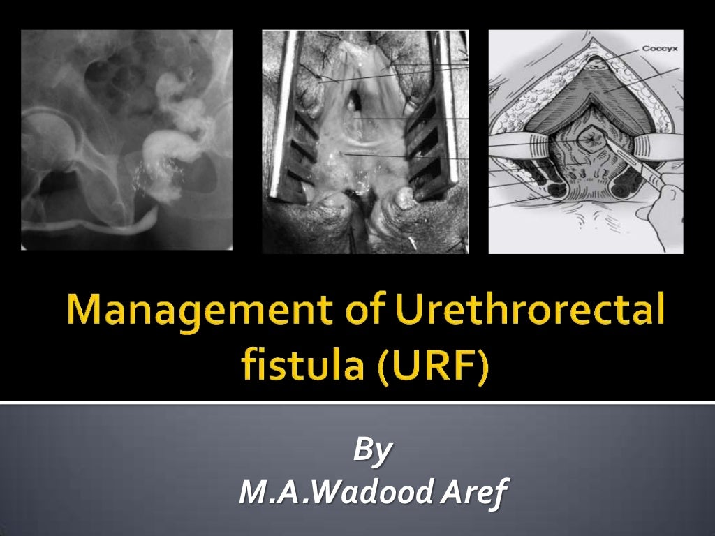 Urethrorectal fistula
