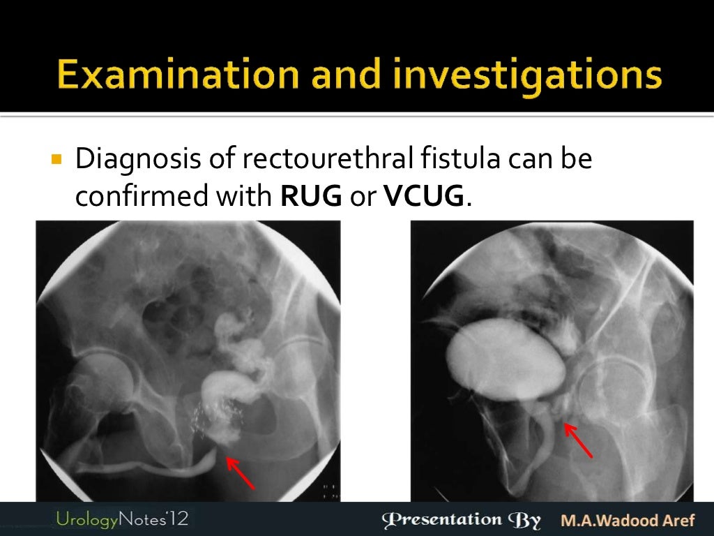 Urethrorectal fistula