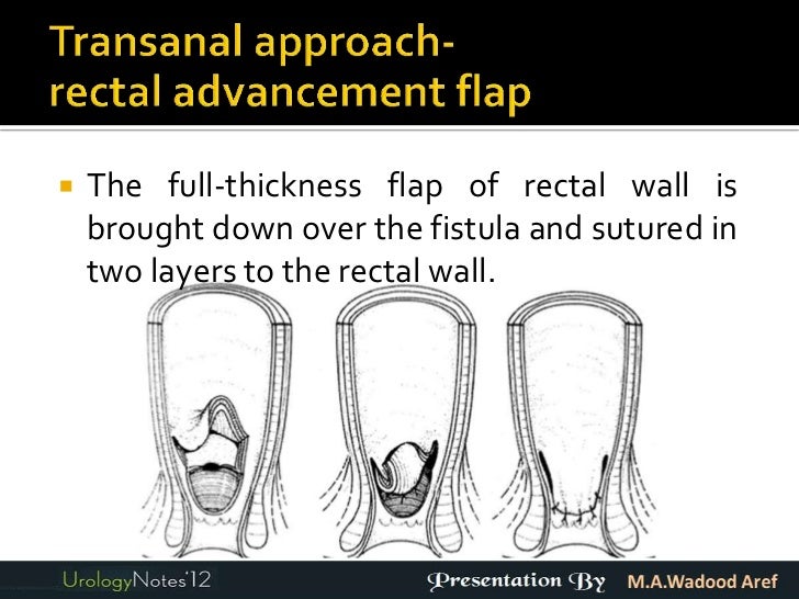 Urethrorectal fistula