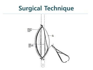 Urethrostomy 요도창냄술 | PPTX