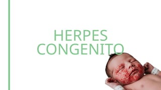 HERPES CONGENITO Y SU AFECTACION AL NEONATO | PPTX