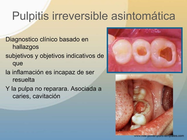 Urgencias y emergencias en odontología pulpitis | PPTX