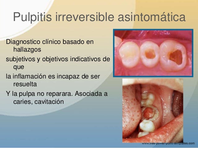 Reversible Pulpitis
